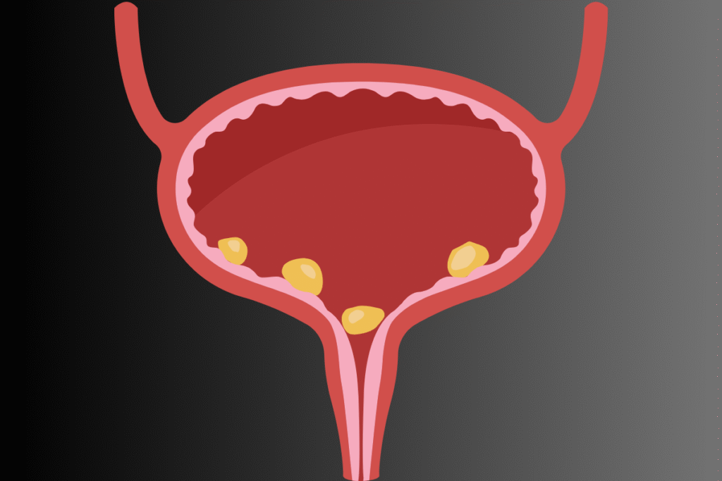 Gall Bladder Stone Ayurveda: Types, Causes, Symptoms & Treatment